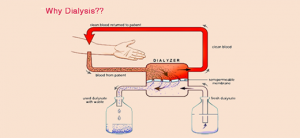 Dialysis | Healthzine-MIOT International