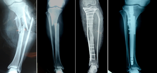 A 25yr old girl with open fracture of both legs treated successfully at ...