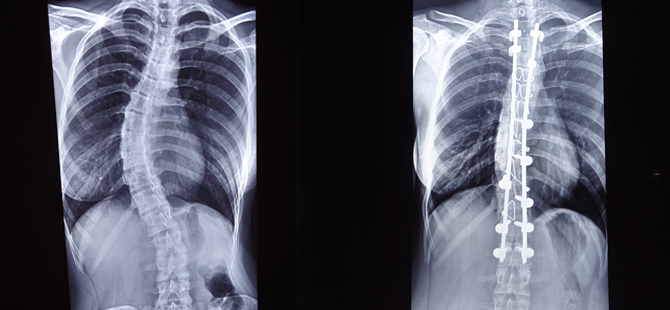 Spine Deformity Correction at MIOT Hospitals, Chennai India